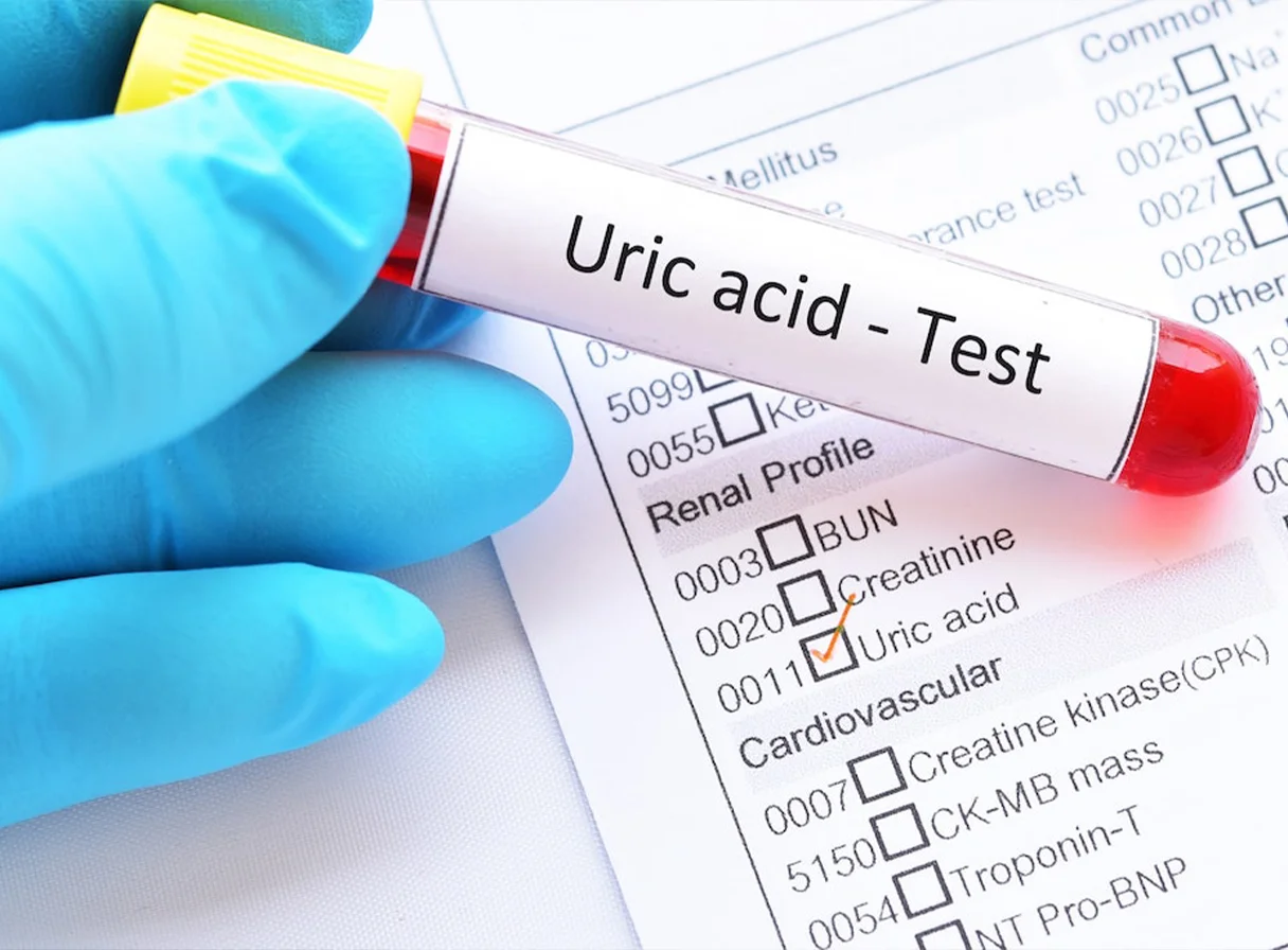 Uric Acid Levels | Normal Range, Tests, and Health Risks | IRIS Hospital